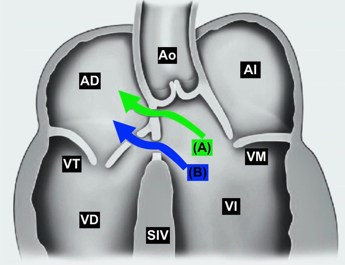 Corrección quirúrgica de un defecto septal tipo Gerbode secundario a ...